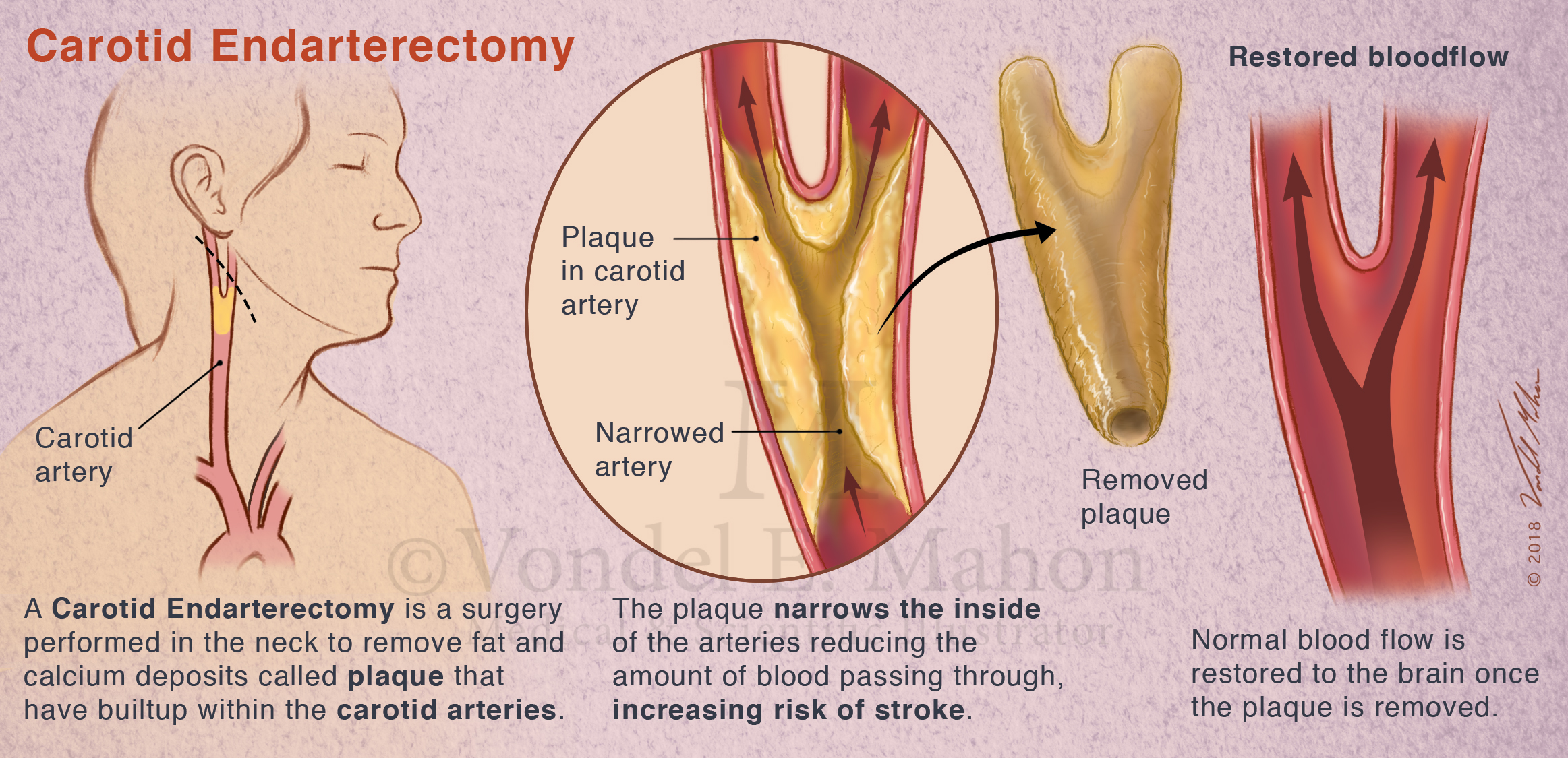 Carotid Endarterectomy Procedure For Patient Education Mahon Carotid Endarterectomy Procedure For Patient Education Mahon